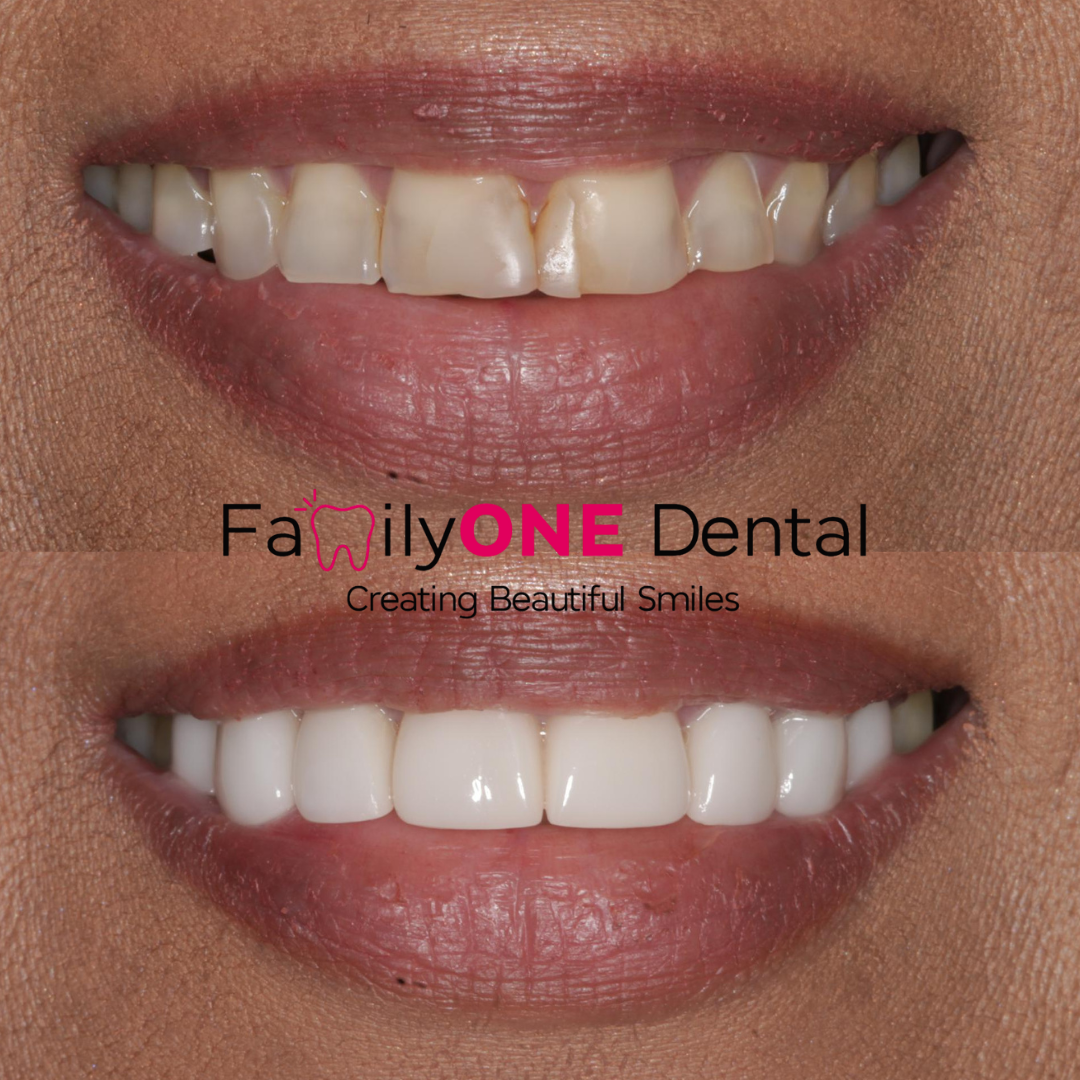 Veneers - FamilyOne Dental