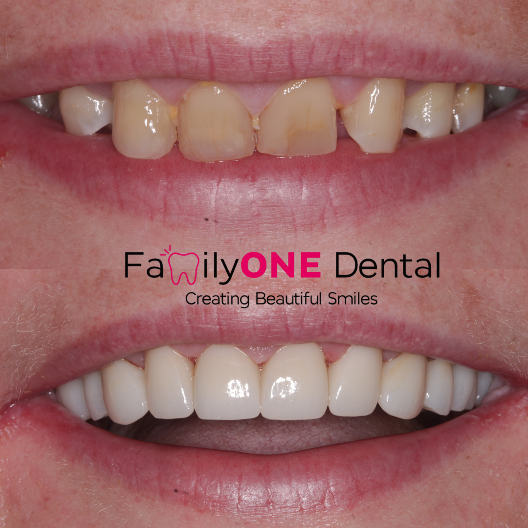 Crowns - FamilyOne Dental