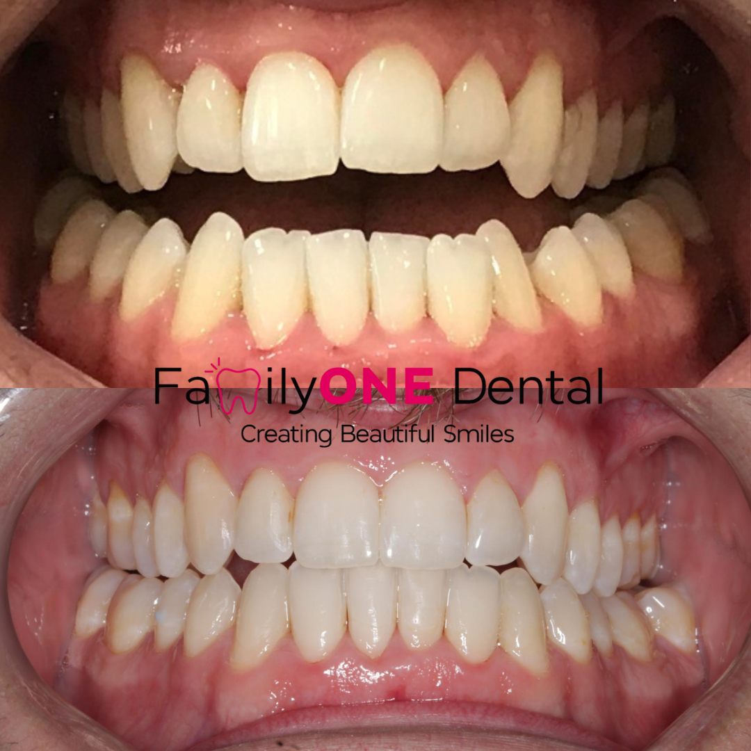 Invisalign in Gold Coast - FamilyOne Dental