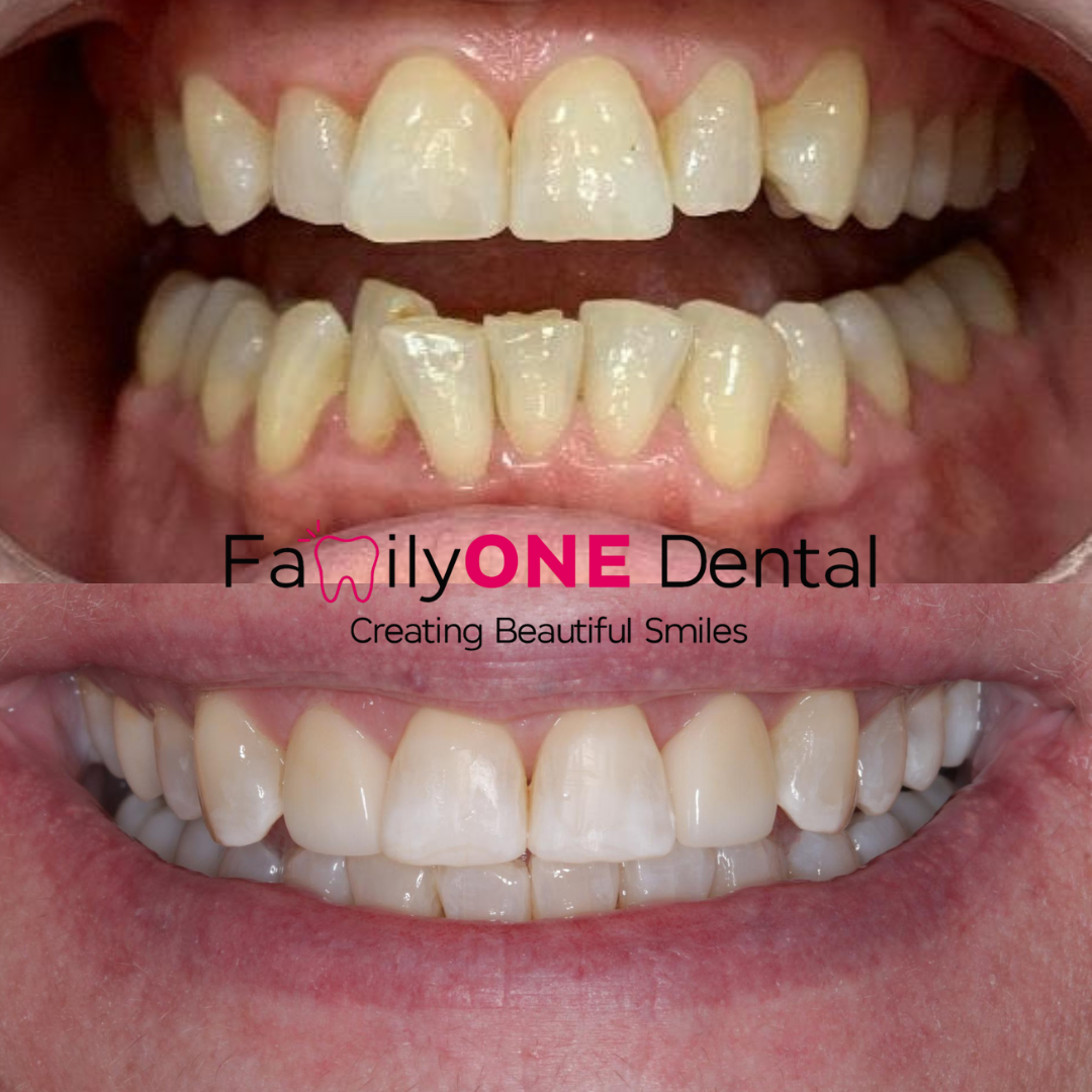 Invisalign in Gold Coast - FamilyOne Dental